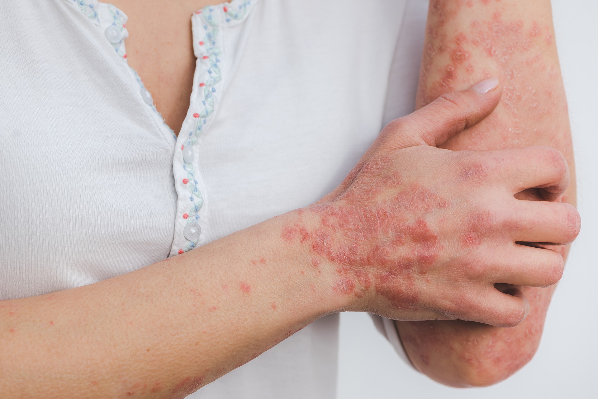 ALLEMAGNE : maladies cutanées et Covid-19 - Eurogip ALLEMAGNE : maladies cutanées et Covid-19 - Eurogip